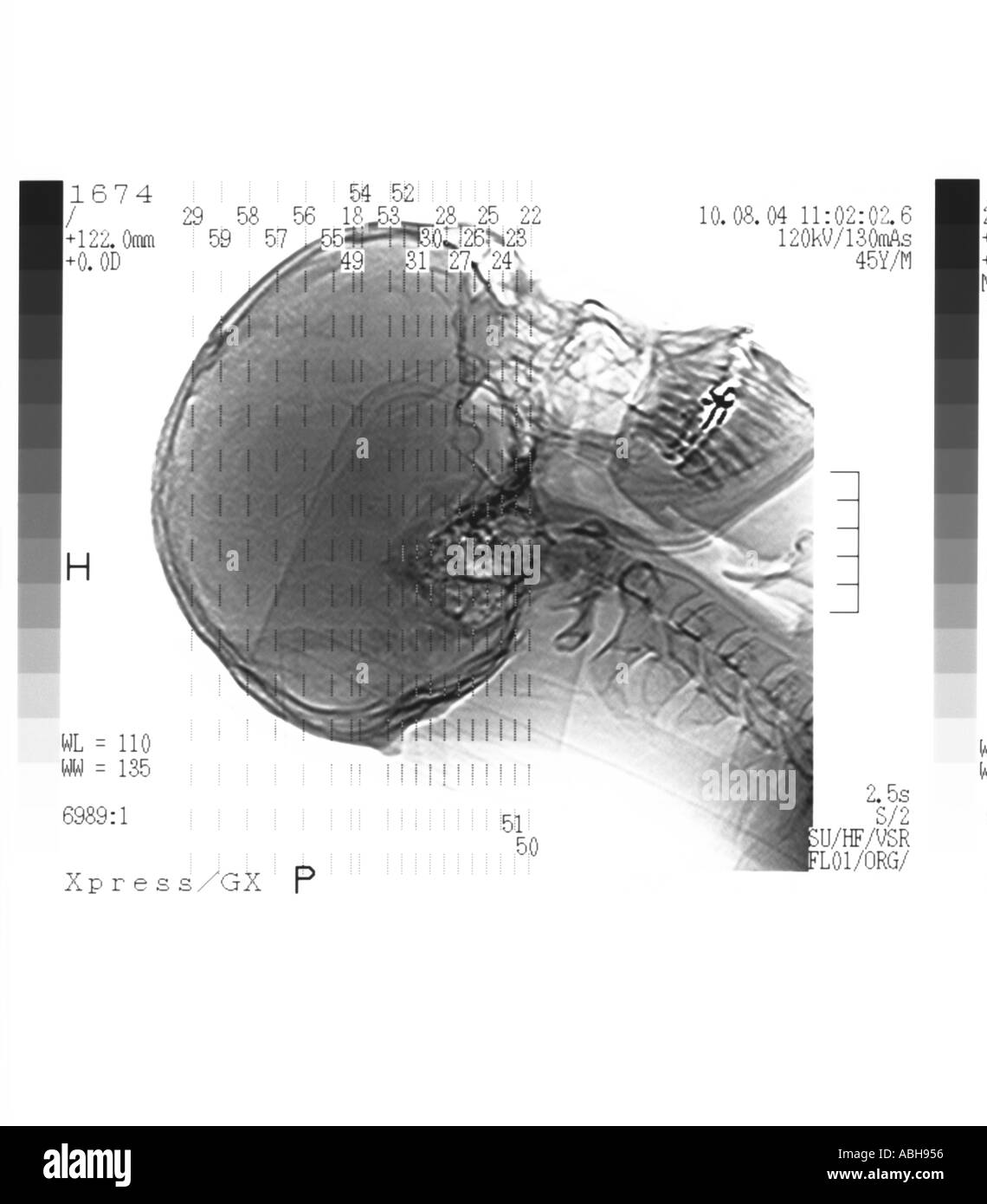 mri scan of skull showing brain positive Stock Photo - Alamy