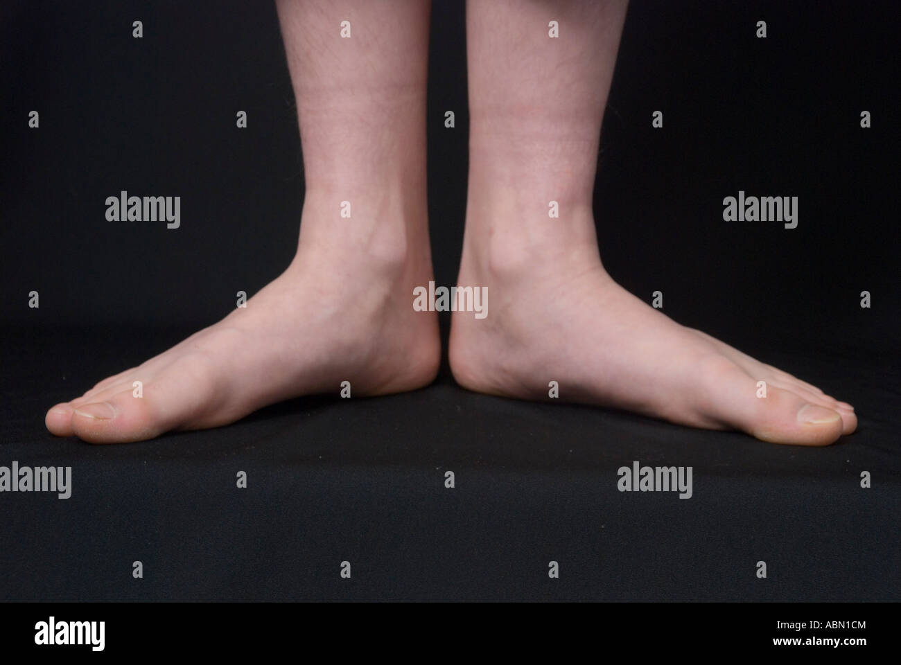 Flat Feet Of 15 Year Old Male Stock Photo Alamy flat-feet-of-15-year-old-male-stock-photo-alamy