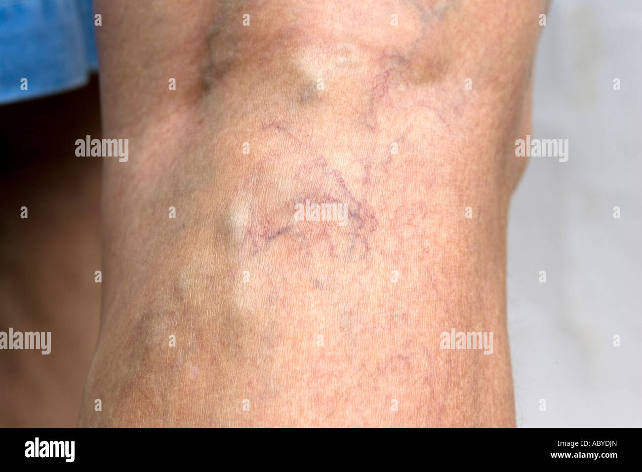 Thread or spider veins on leg of elderly woman UK Stock Photo - Alamy