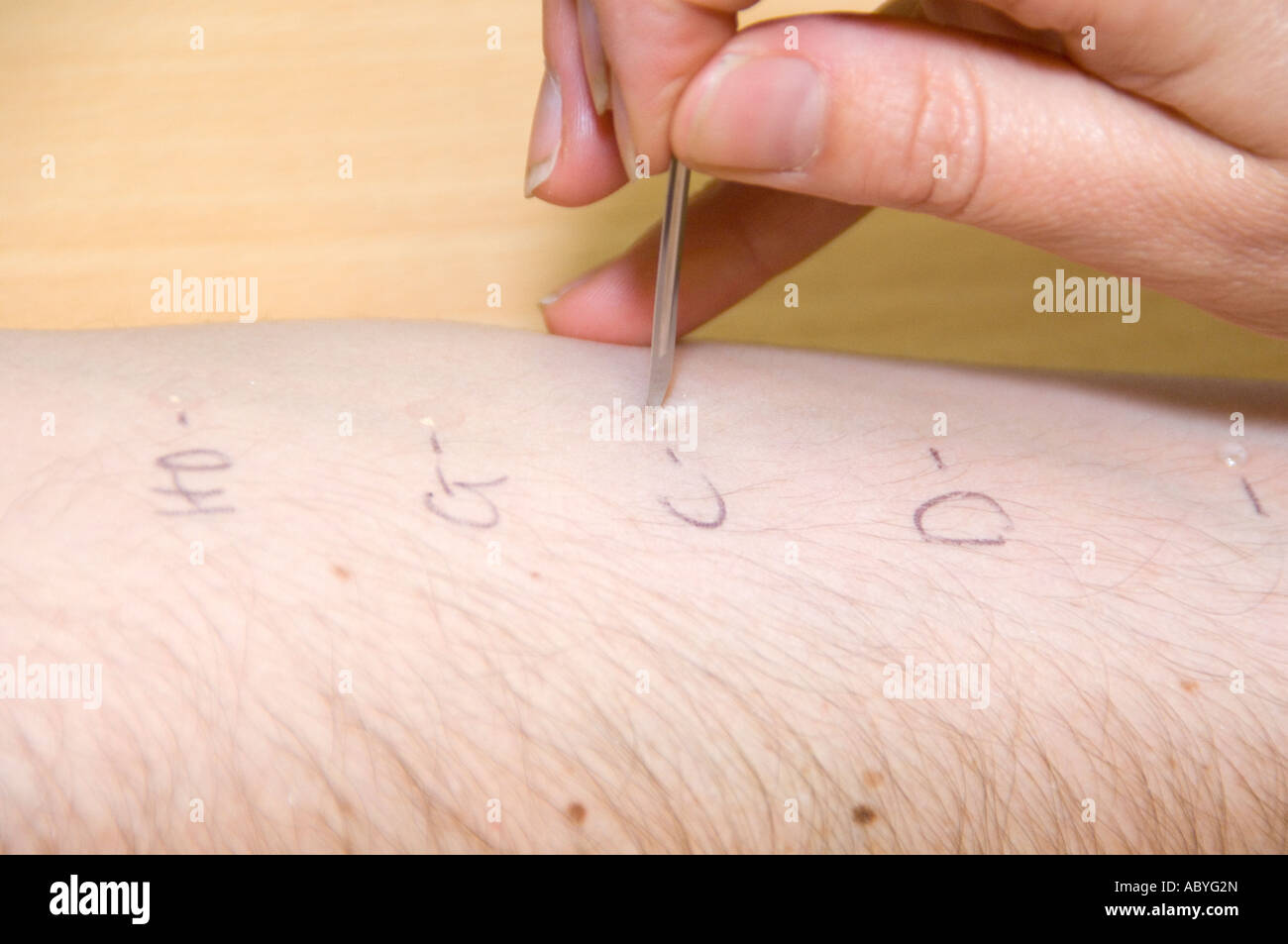 Performing Skin prick test for diagnosis of atopy and allergy Stock ...