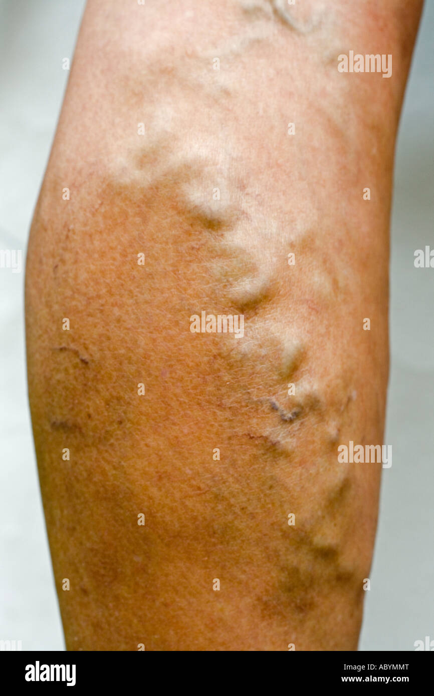 Leg Blood Vessels Stock Photos & Leg Blood Vessels Stock Images - Alamy