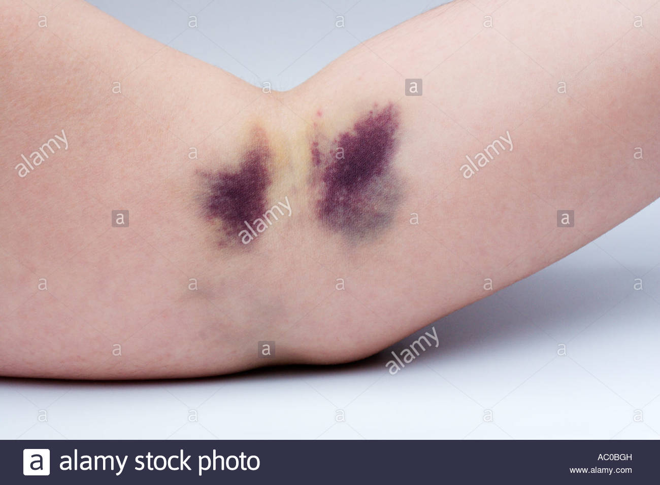 Bruise Arm High Resolution Stock Photography and Images - Alamy