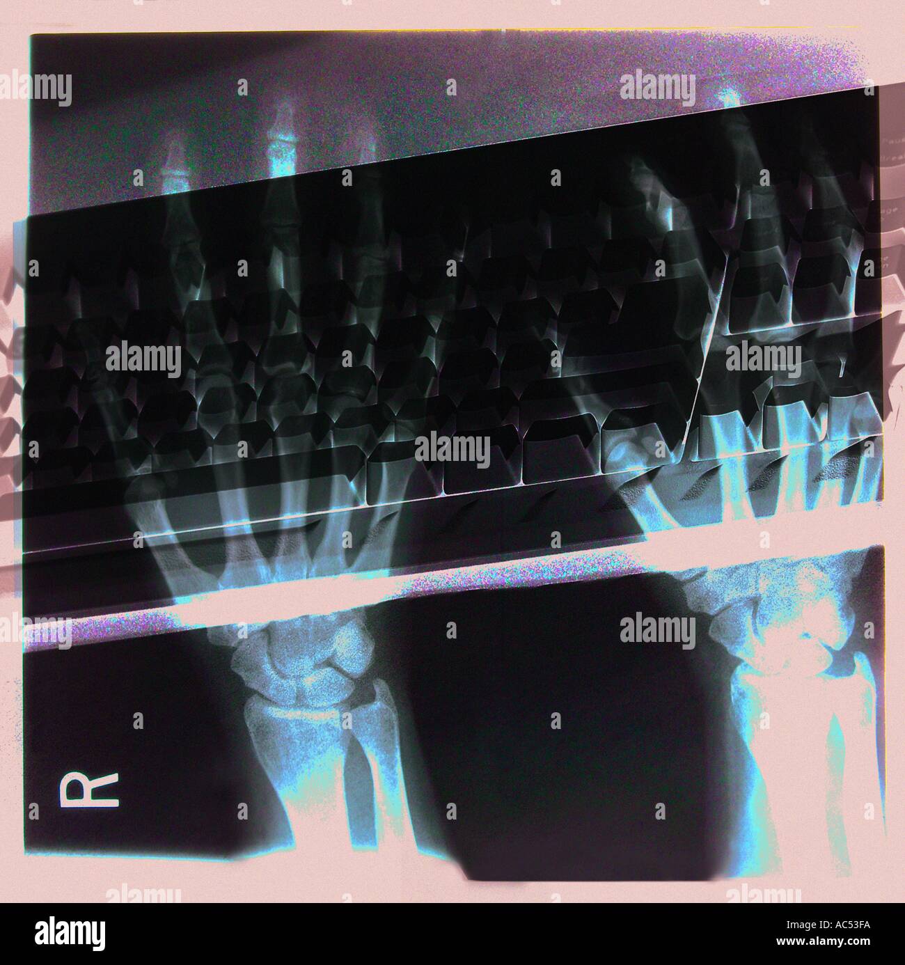X ray hands on keyboard hi-res stock photography and images - Alamy