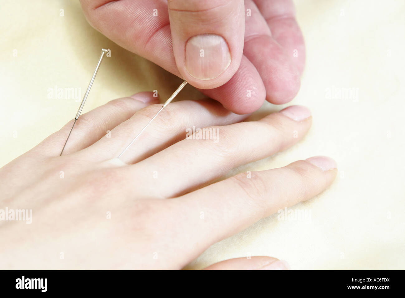 Inserting of acupuncture needle to the hand Stock Photo - Alamy