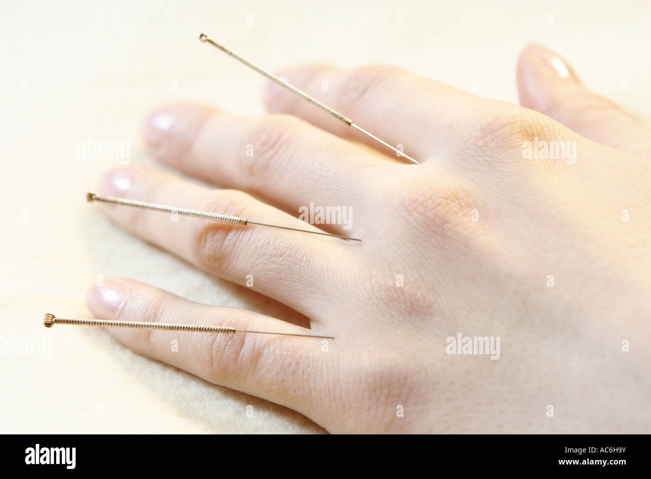 Acupuncture needles in the hand Stock Photo - Alamy