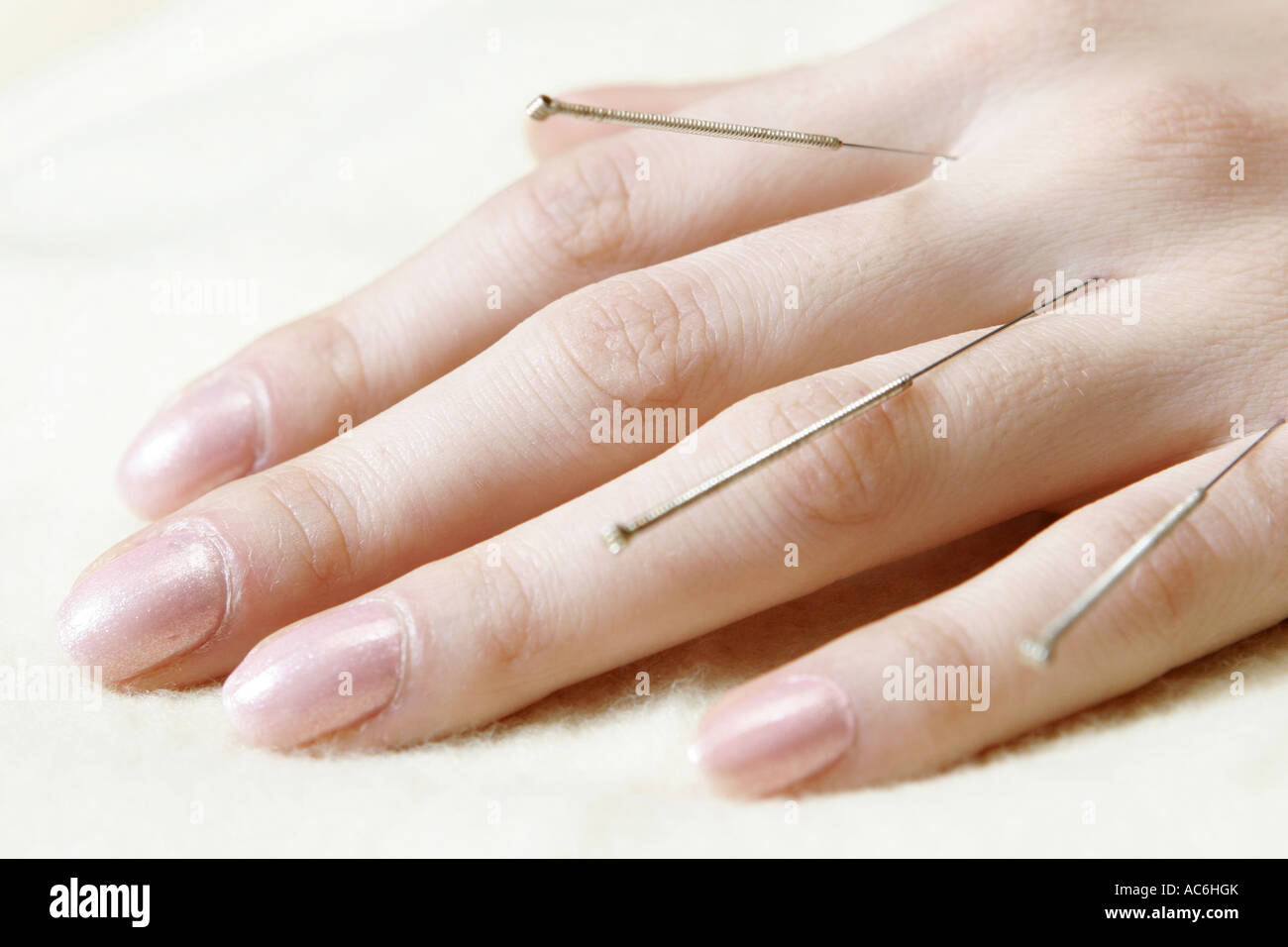 Acupuncture needles in the hand Stock Photo - Alamy