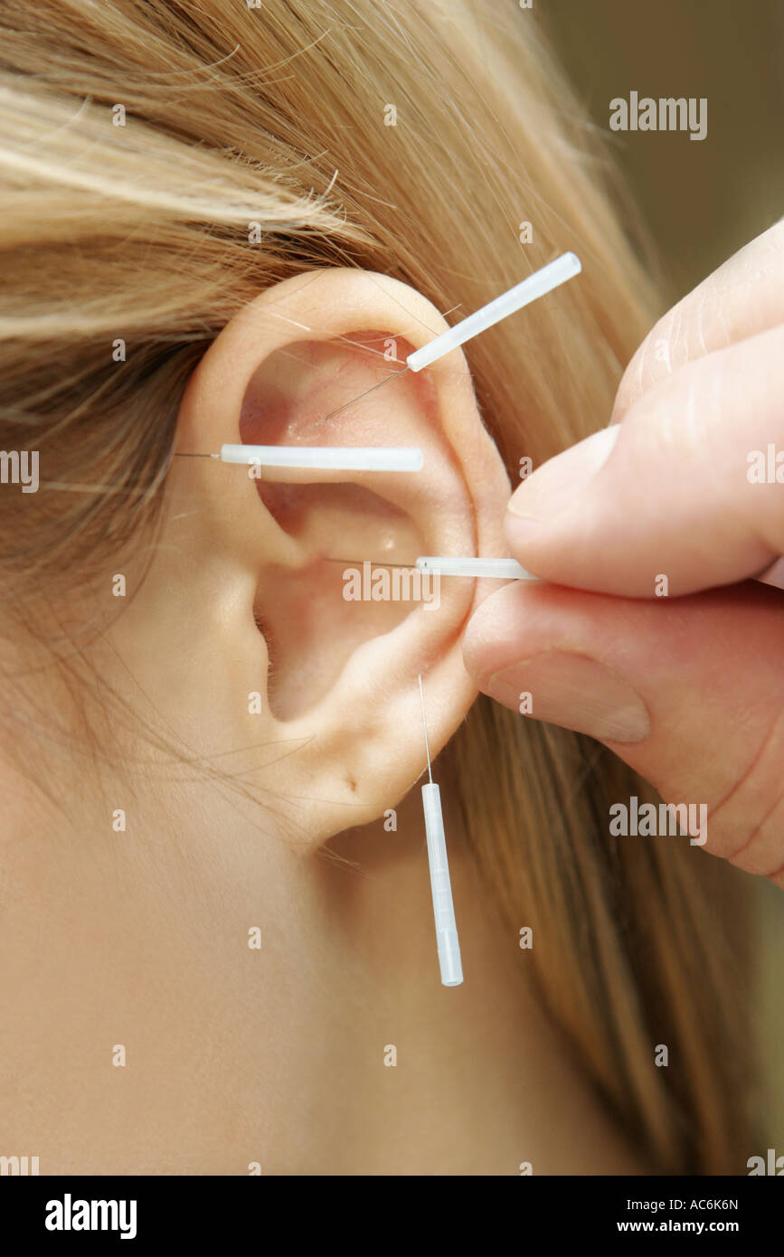 Acupuncture needles in the ear Stock Photo - Alamy
