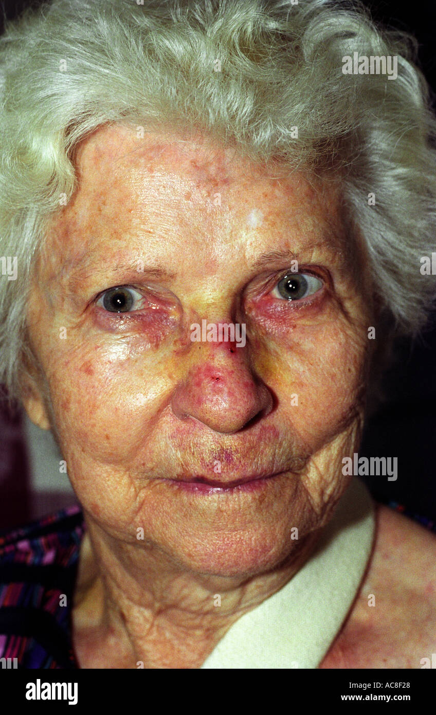 older woman with bruised face after fall in parking lot 1558 Stock ...