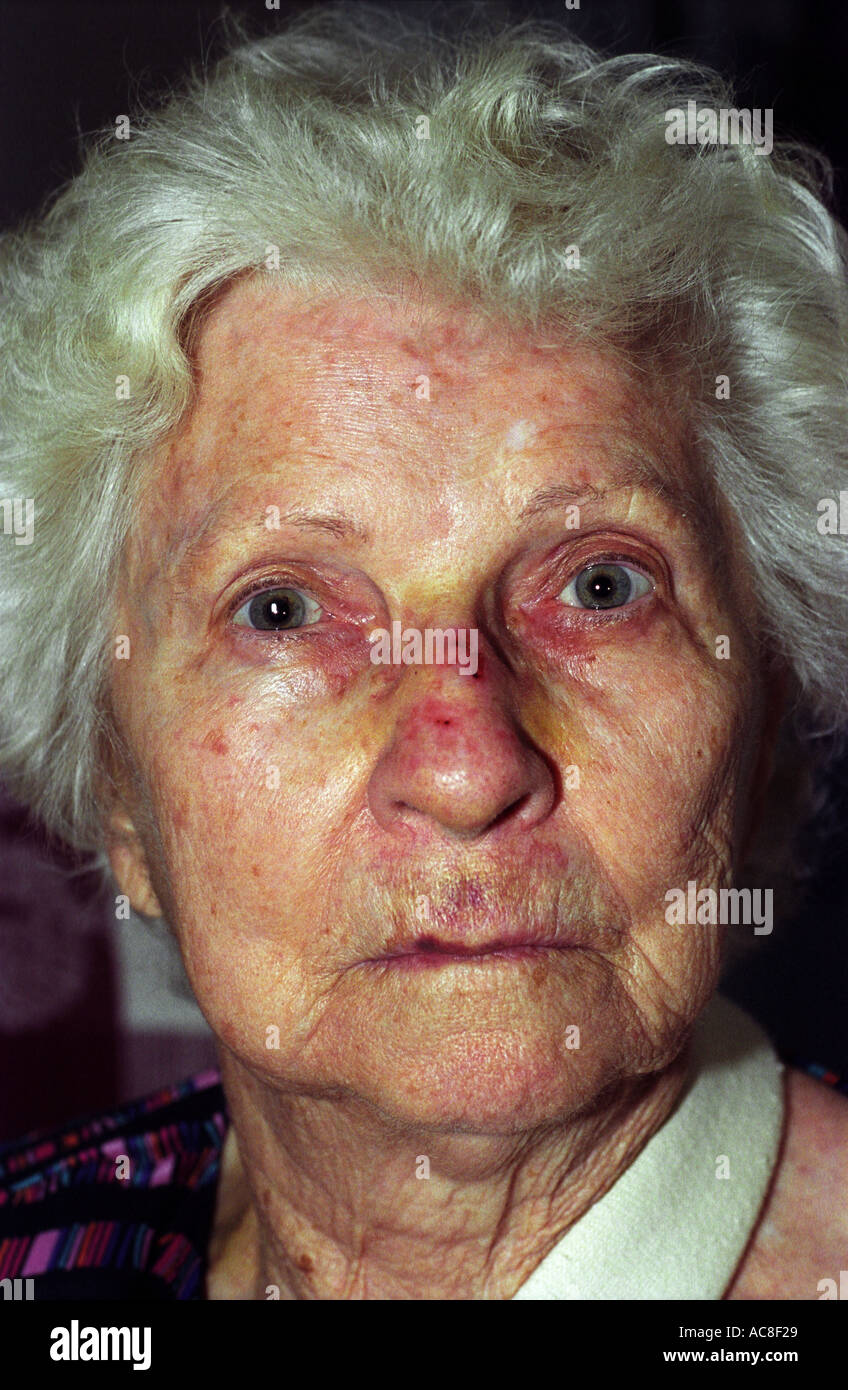 Bruised face hi-res stock photography and images - Alamy