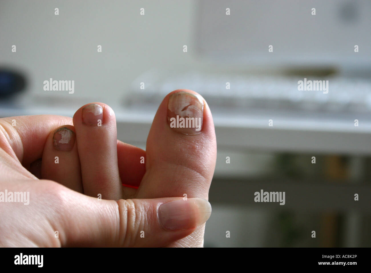 Dirty toe nails hi-res stock photography and images - Alamy