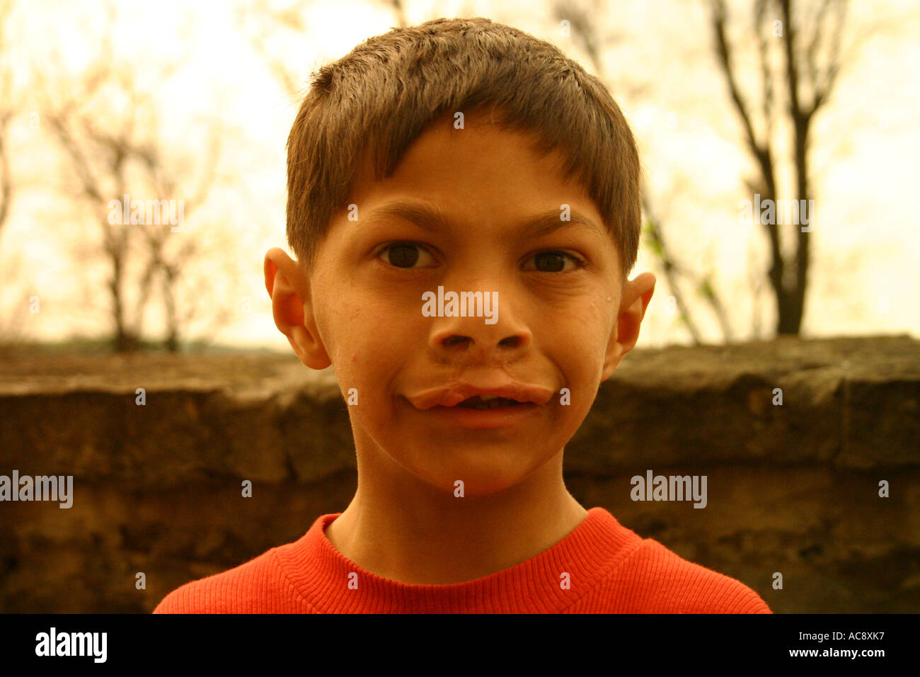 A young disabled gypsy child staring into the camera Stock Photo - Alamy