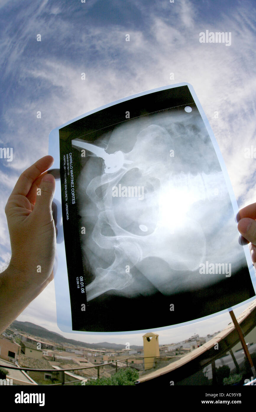 Roentgenogram hi-res stock photography and images - Alamy