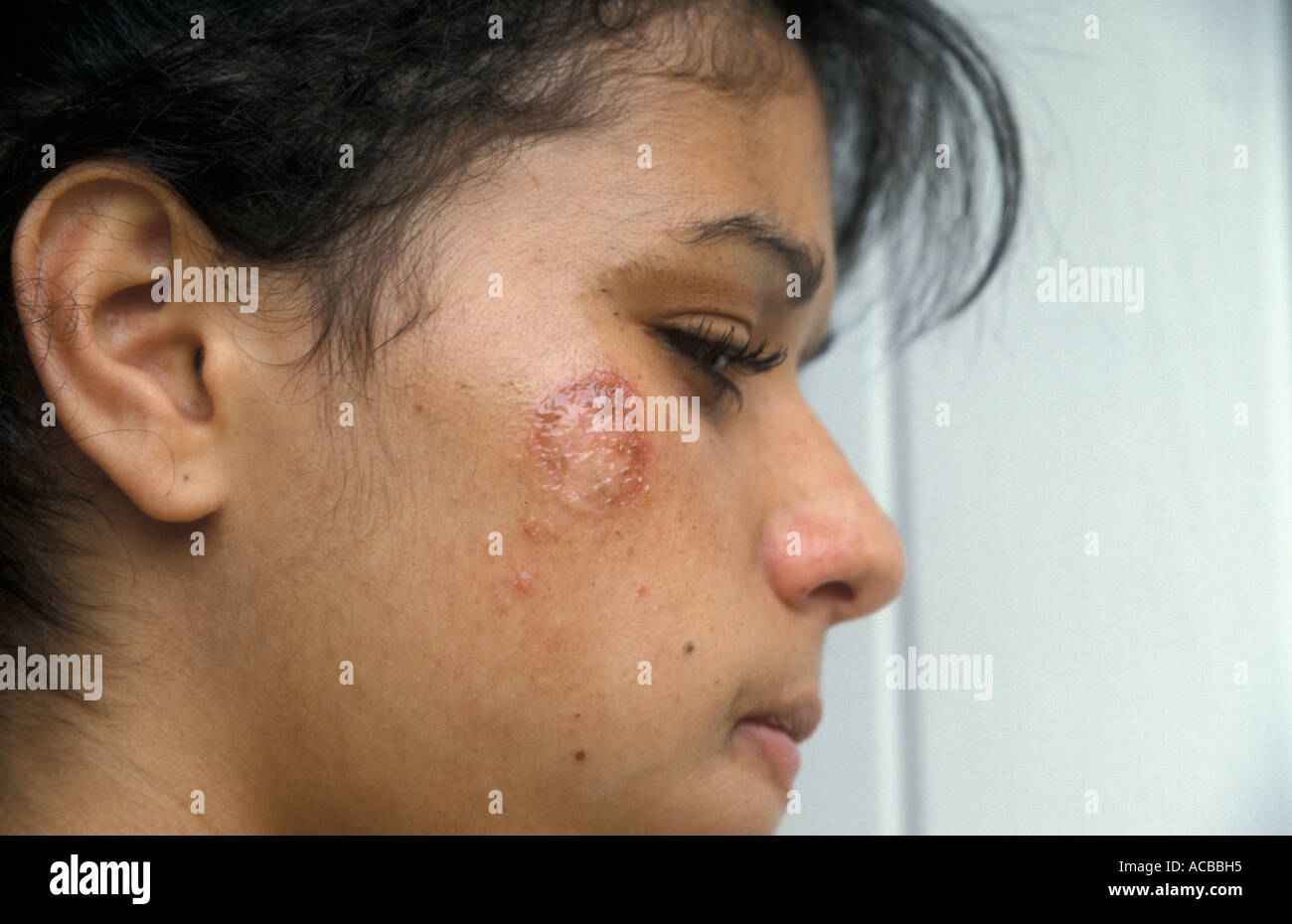Impetigo hi-res stock photography and images - Alamy