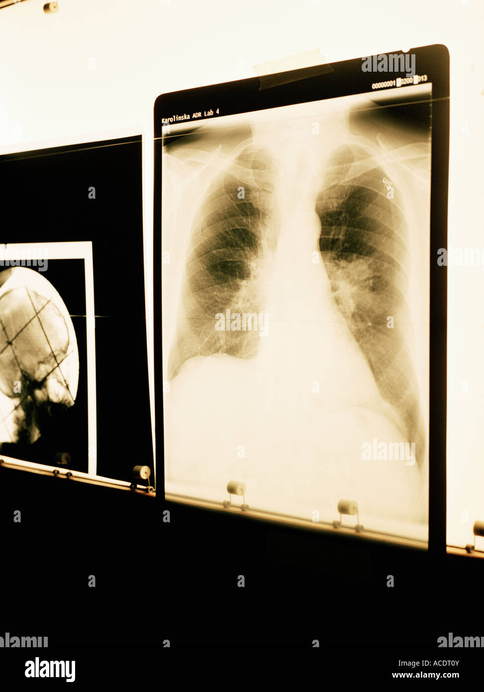 Cancer ward hi-res stock photography and images - Alamy
