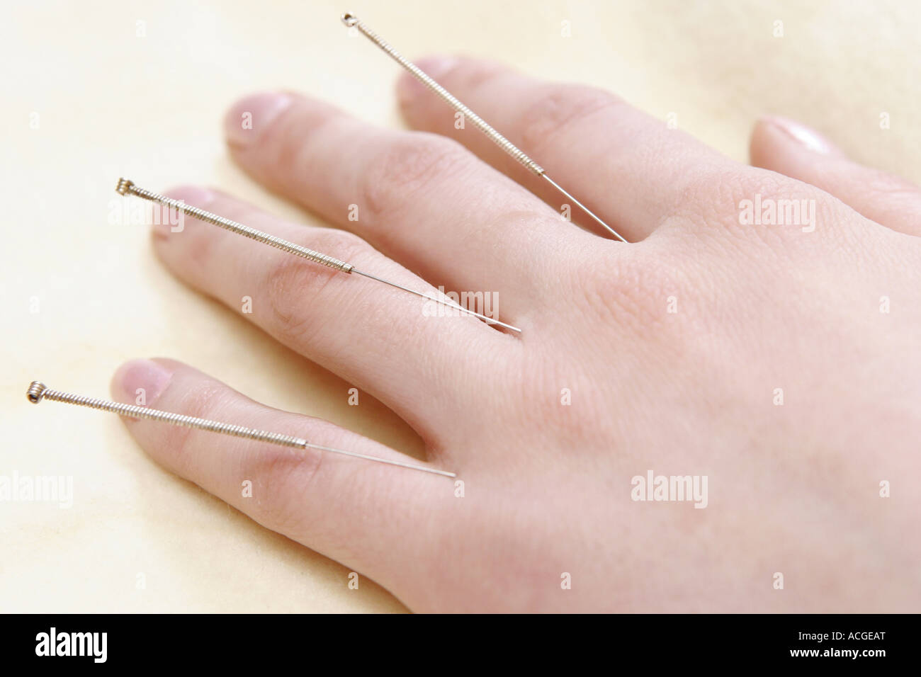 Acupuncture needles in the hand Stock Photo - Alamy