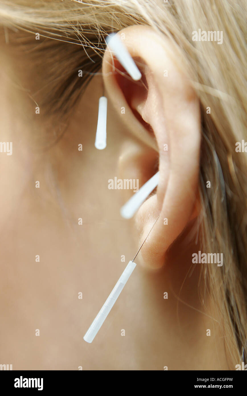 Acupuncture needles in the ear Stock Photo - Alamy