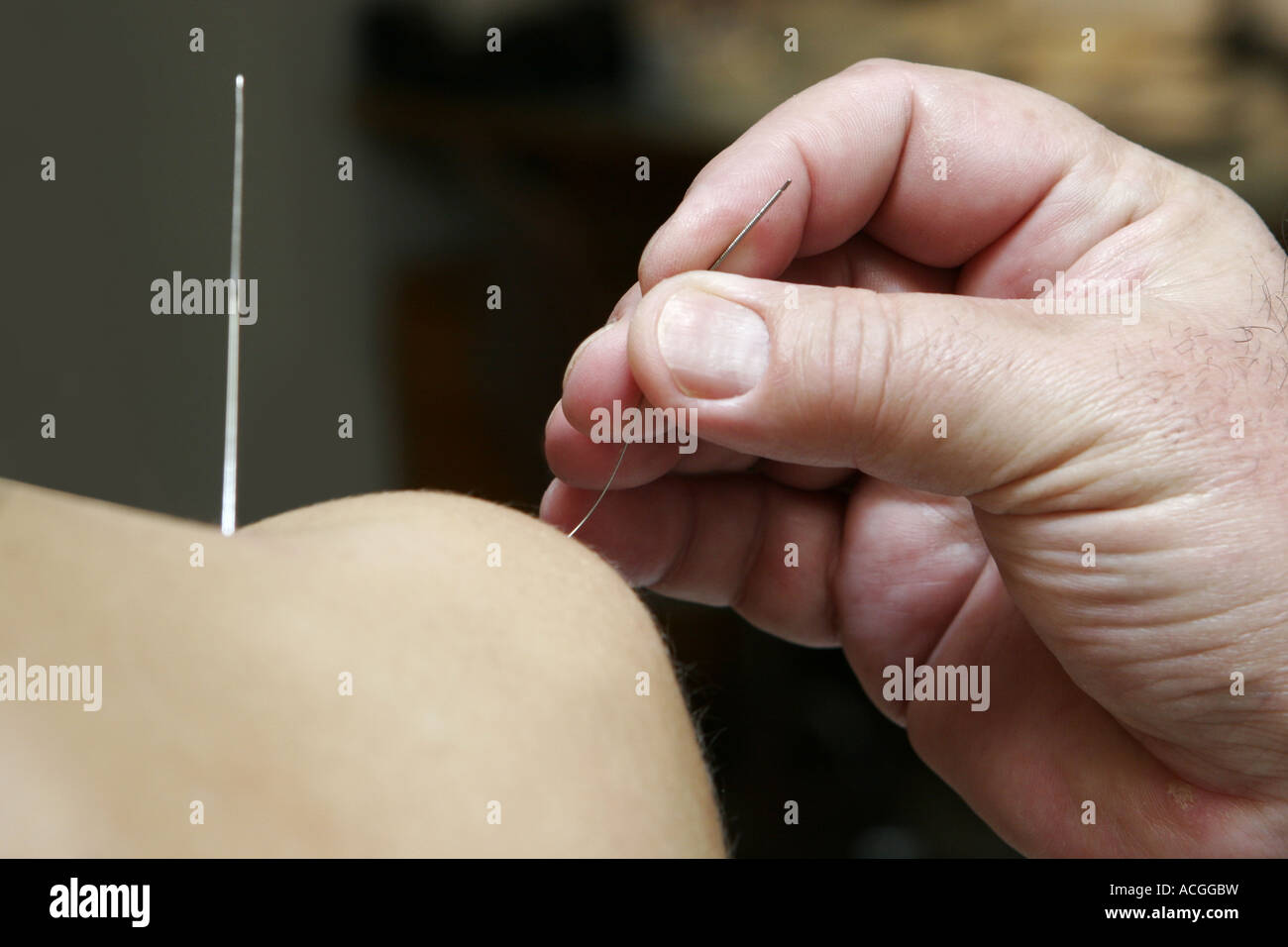 Inserting of acupuncture needle to the shoulder Stock Photo - Alamy