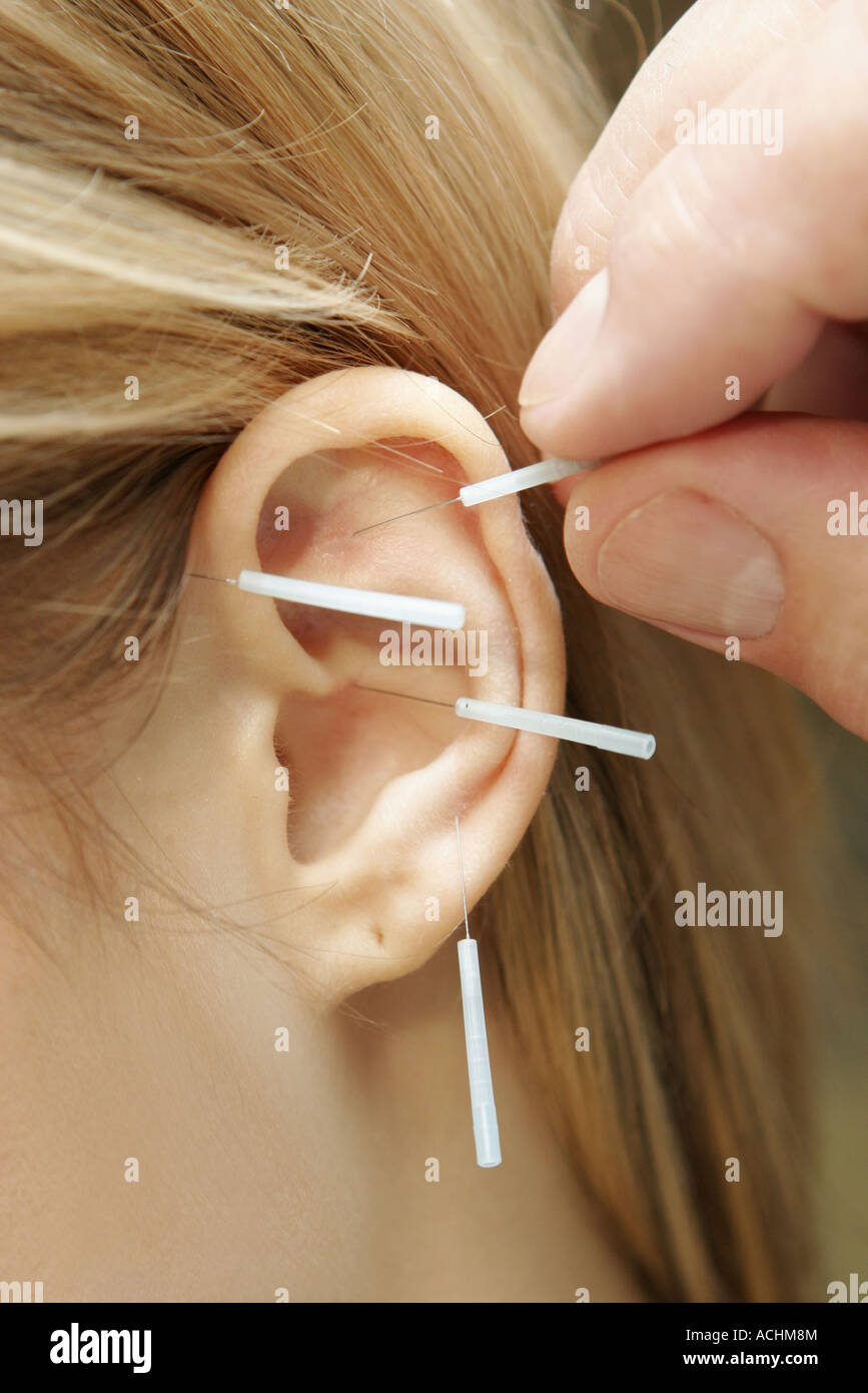 Acupuncture needles in the ear Stock Photo - Alamy