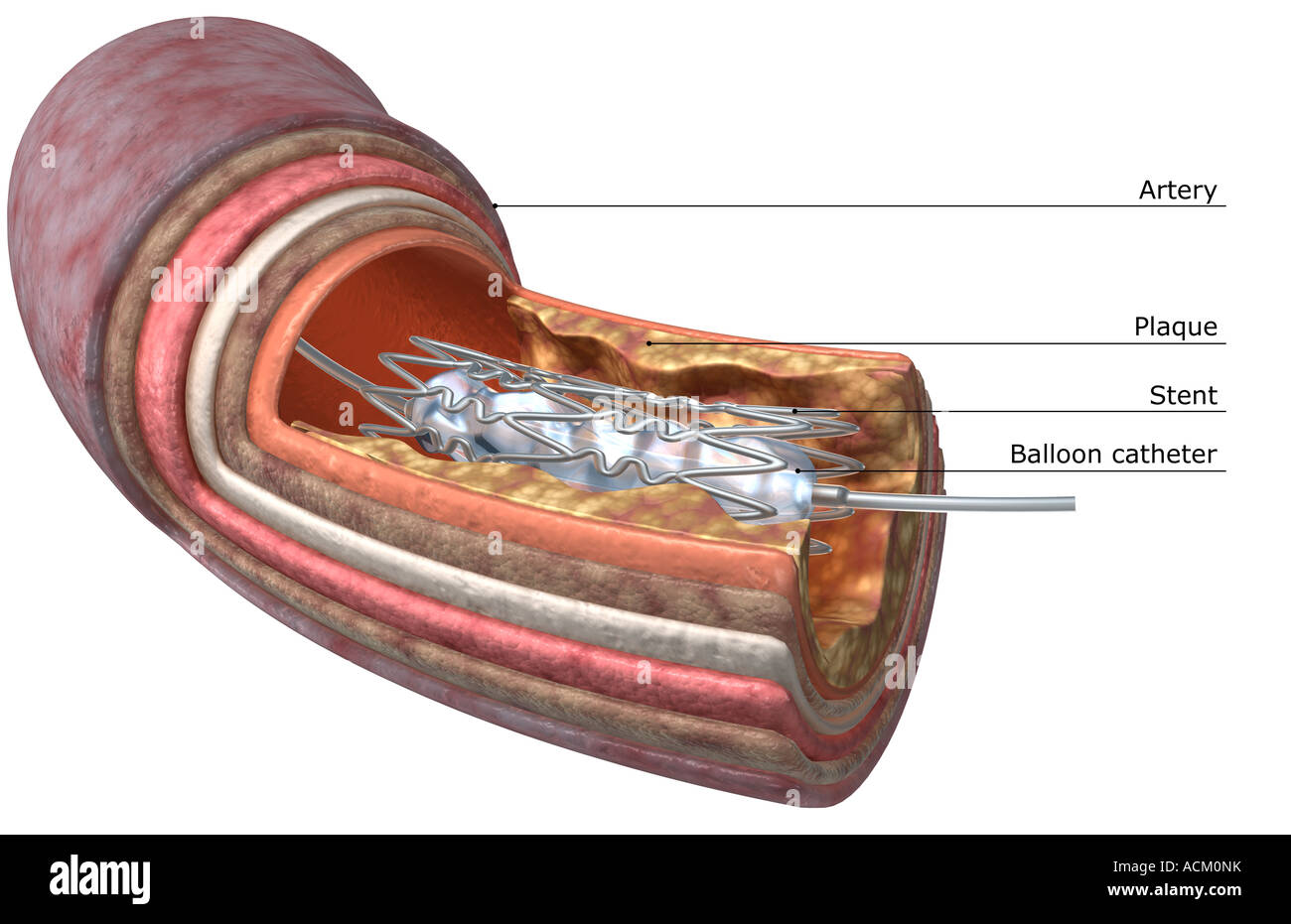 Atheroma plaques Cut Out Stock Images & Pictures - Alamy