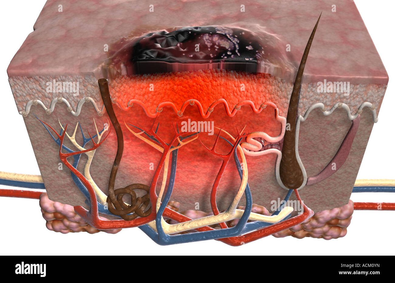 Malignant melanoma skin hi-res stock photography and images - Alamy