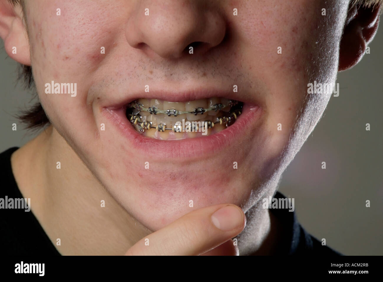 Teenage boy parting his lips to show off the fixed orthodontic braces ...