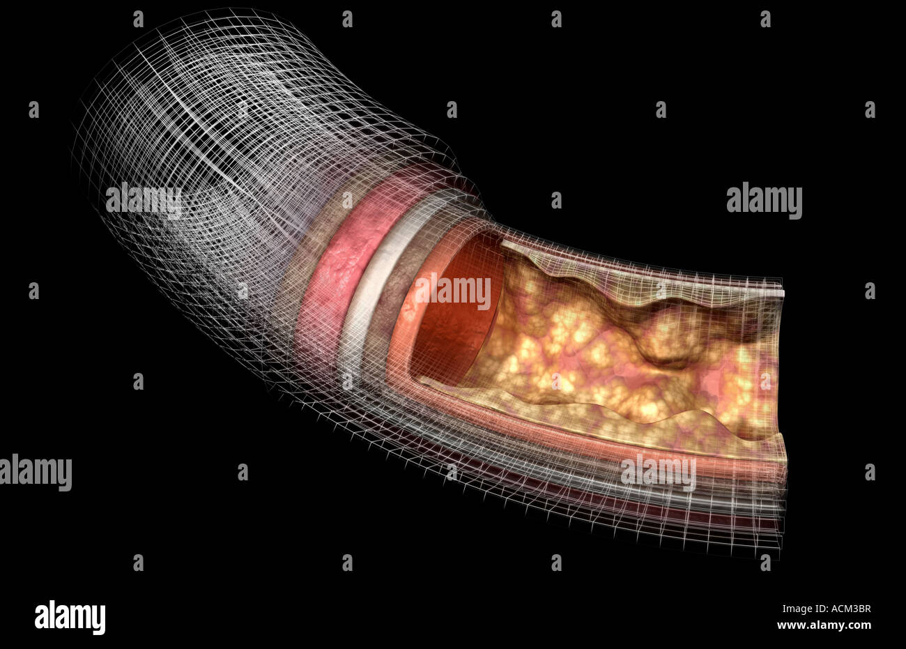 Arterial plaques hi-res stock photography and images - Alamy