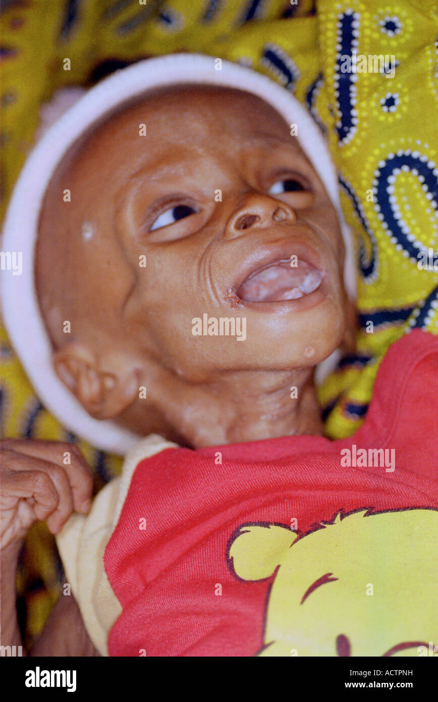 Acquired immunodeficiency syndrome hi-res stock photography and images ...