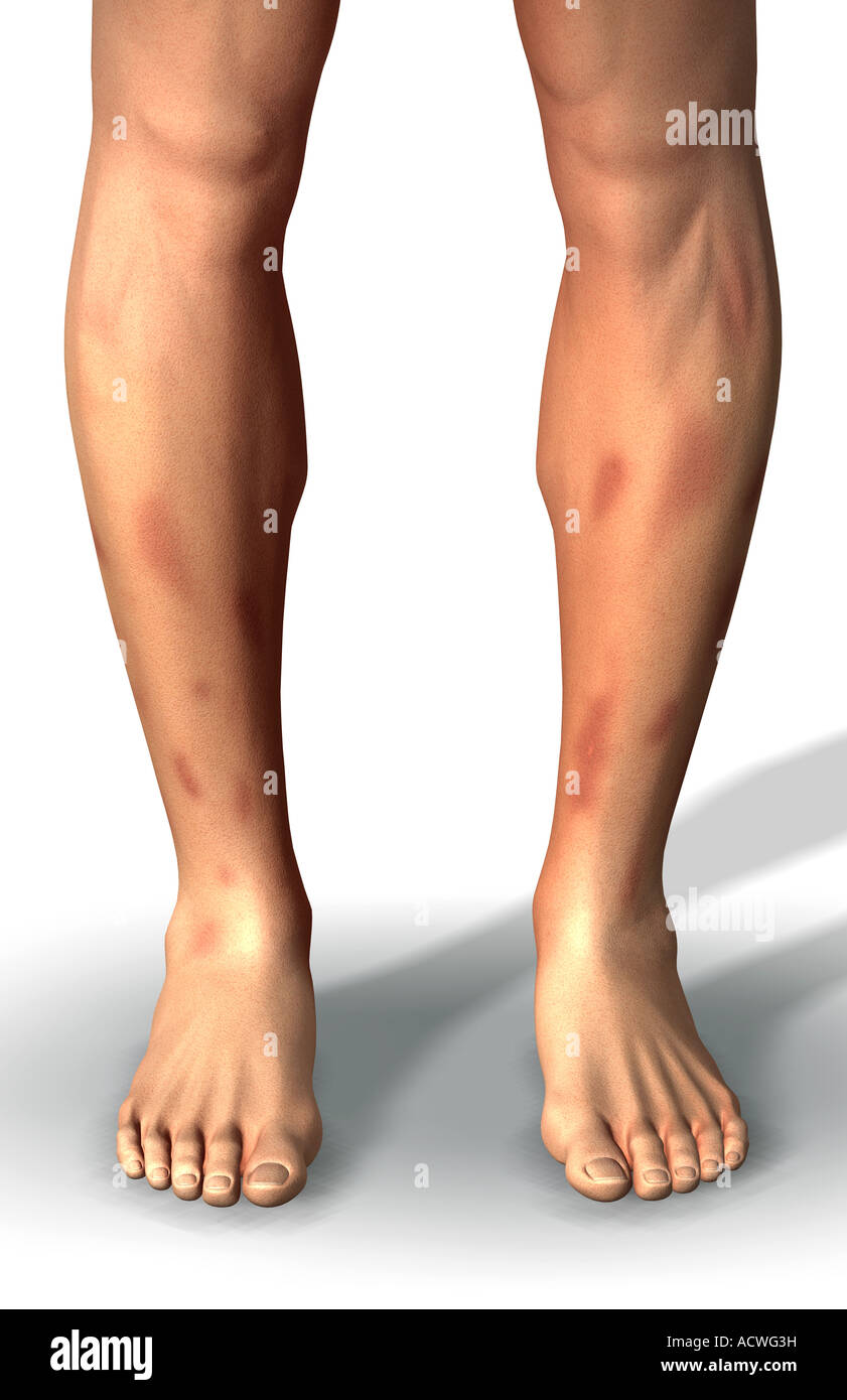 Erythema nodosum hi-res stock photography and images - Alamy