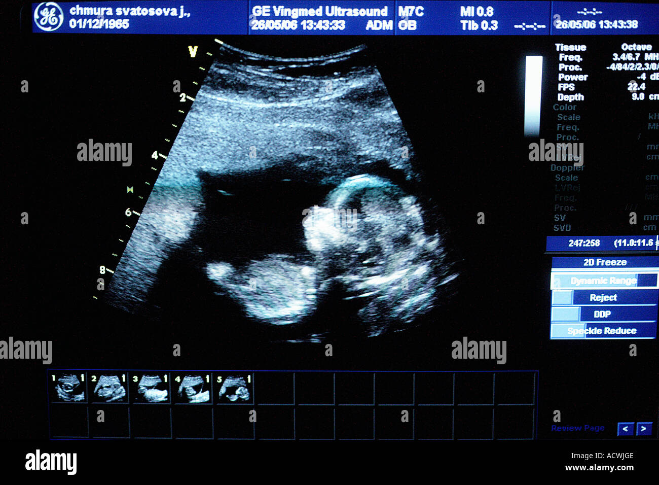 Tiny ultrasound hi-res stock photography and images - Alamy