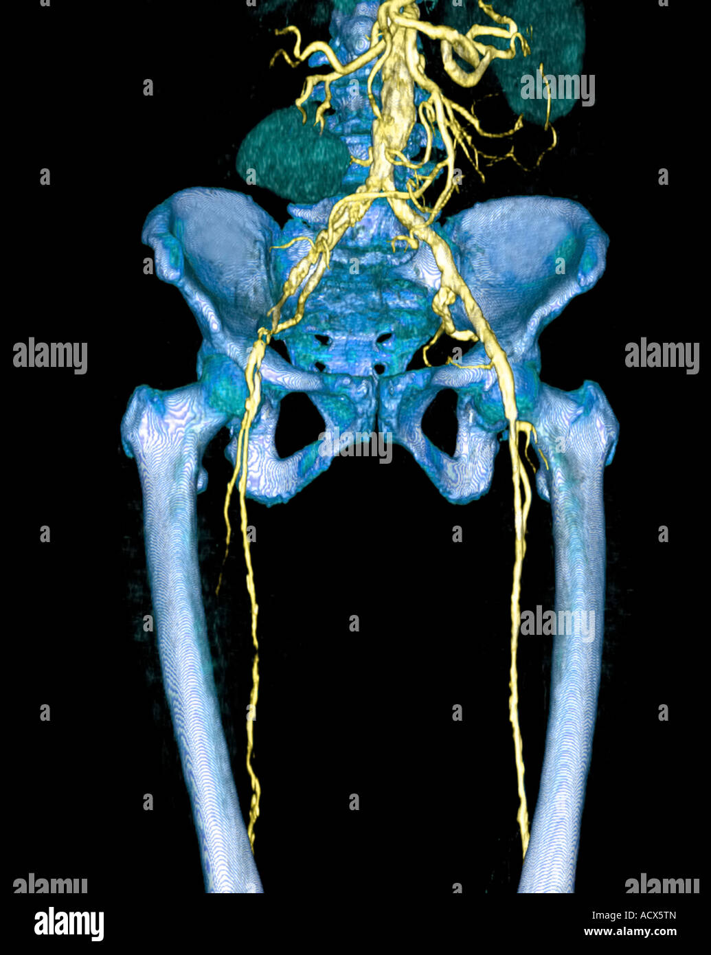 3D CT scan showing 83 year old female with right iliac artery occlusion ...