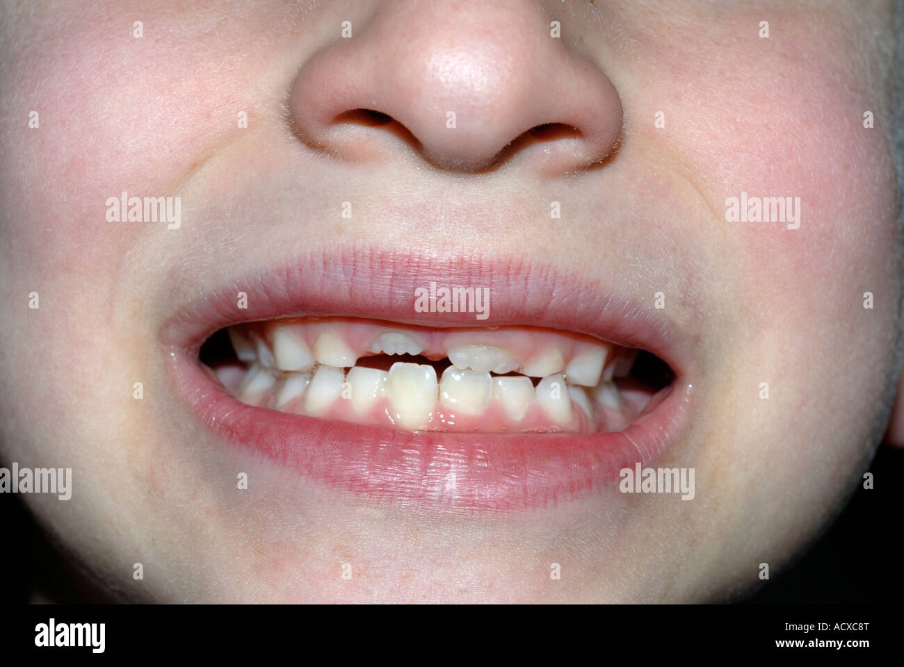Incisors hi-res stock photography and images - Alamy