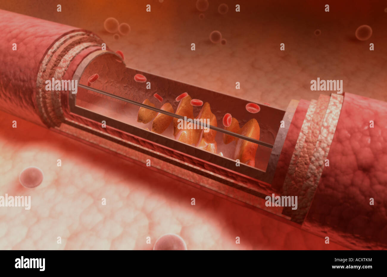 Angioplasty hi-res stock photography and images - Alamy