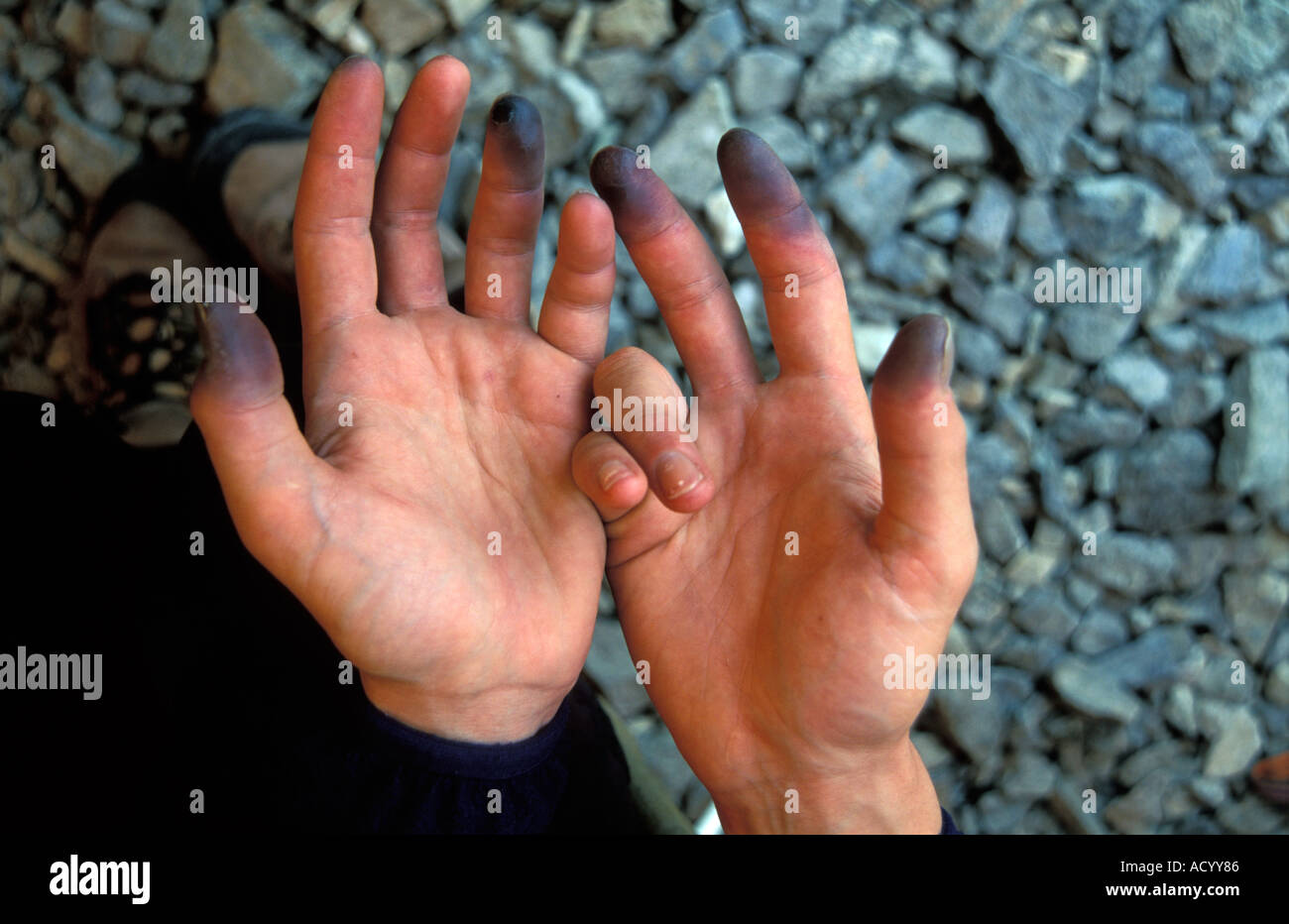 Frostbite hi-res stock photography and images - Alamy