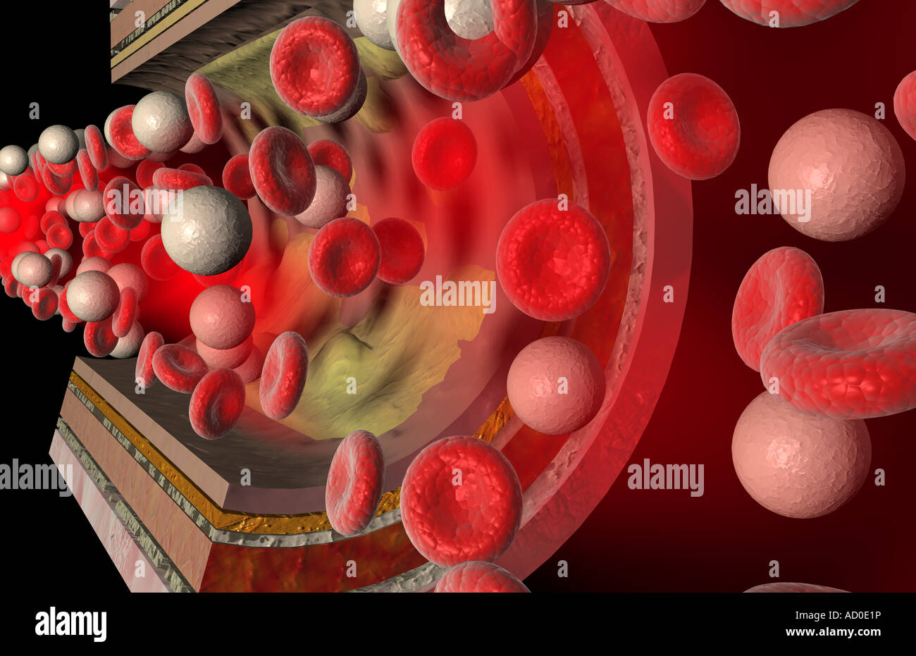 Atheroma plaques hi-res stock photography and images - Alamy