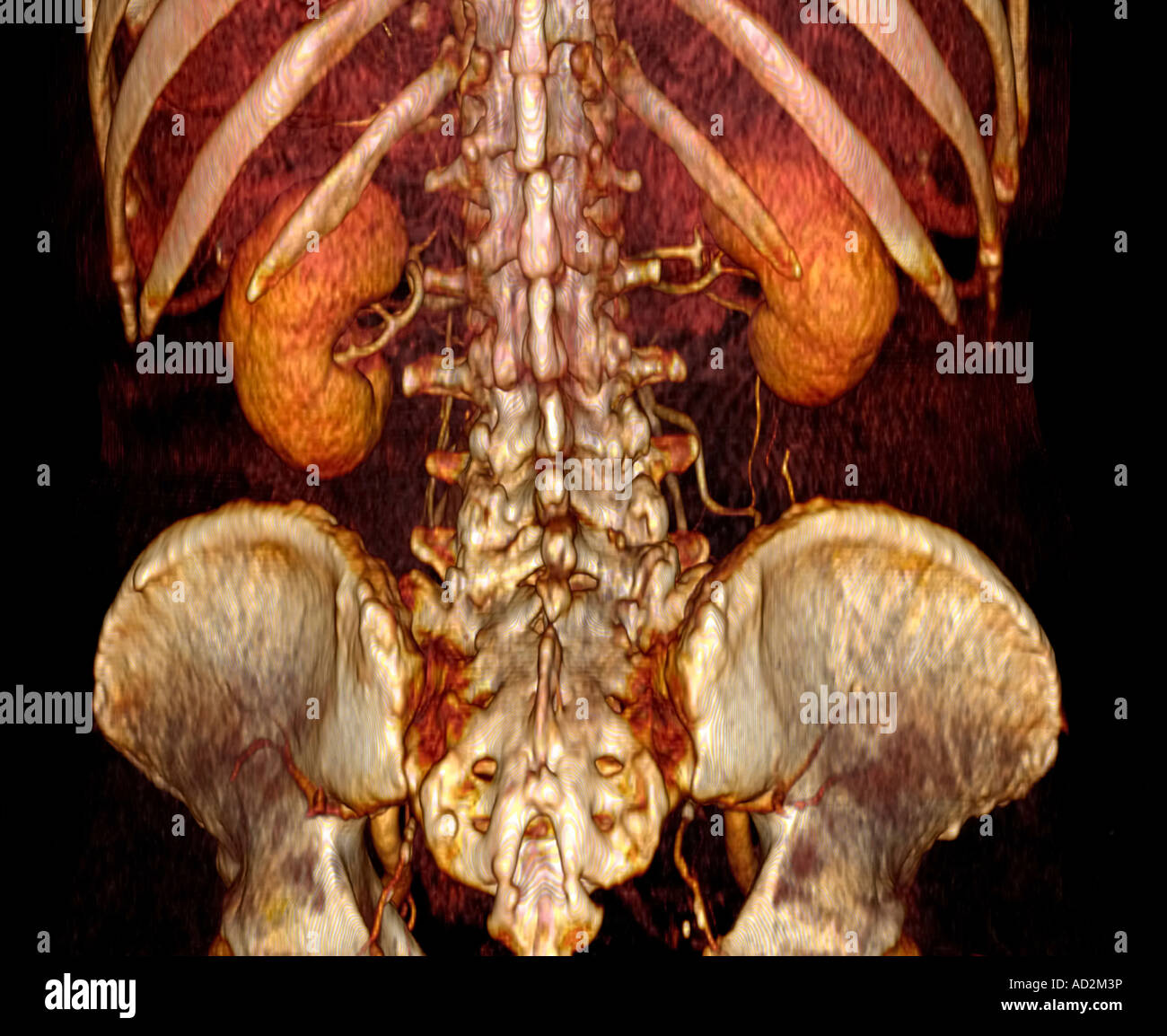 A normal 3D CT scan acquired on a 16 detector scanner showing the back ...
