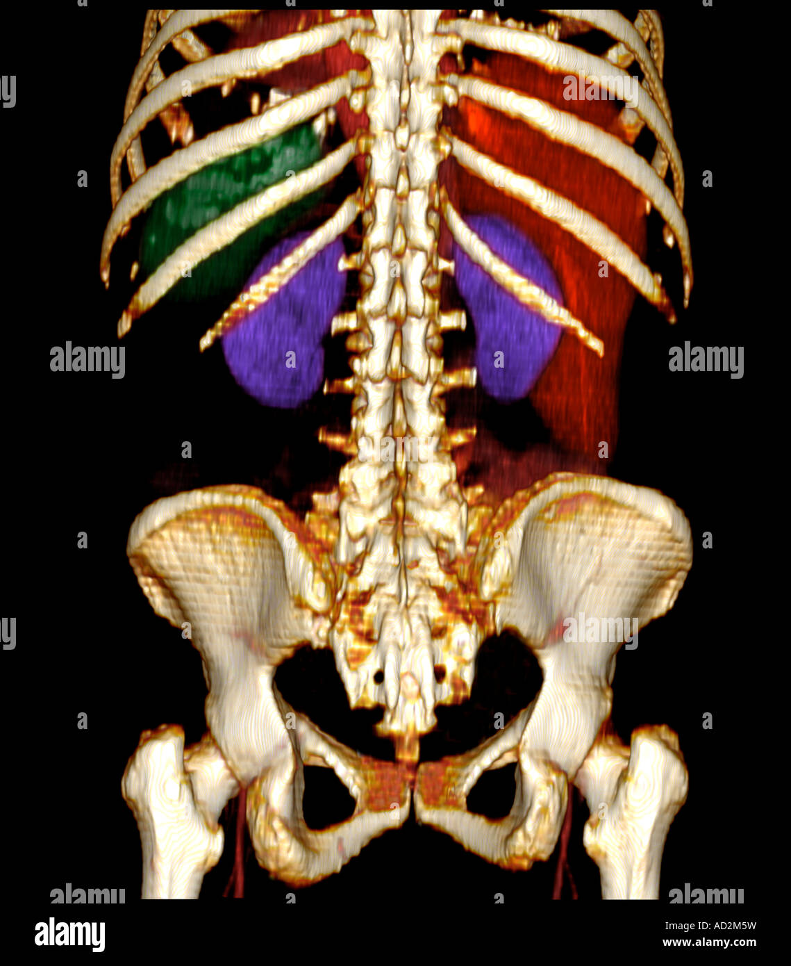 3D CT body scan of a 77 year old female viewed from the back showing ...