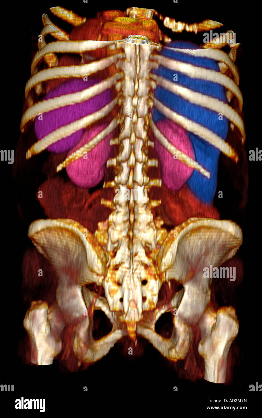 3D CT body scan of a 77 year old female viewed from the back showing ...
