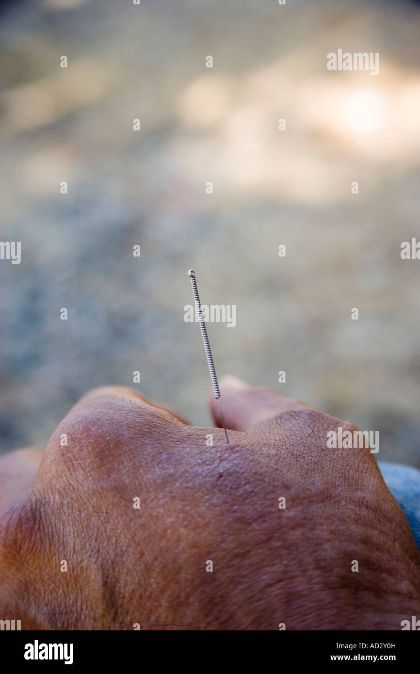 Male hand treated with acupuncture Stock Photo - Alamy