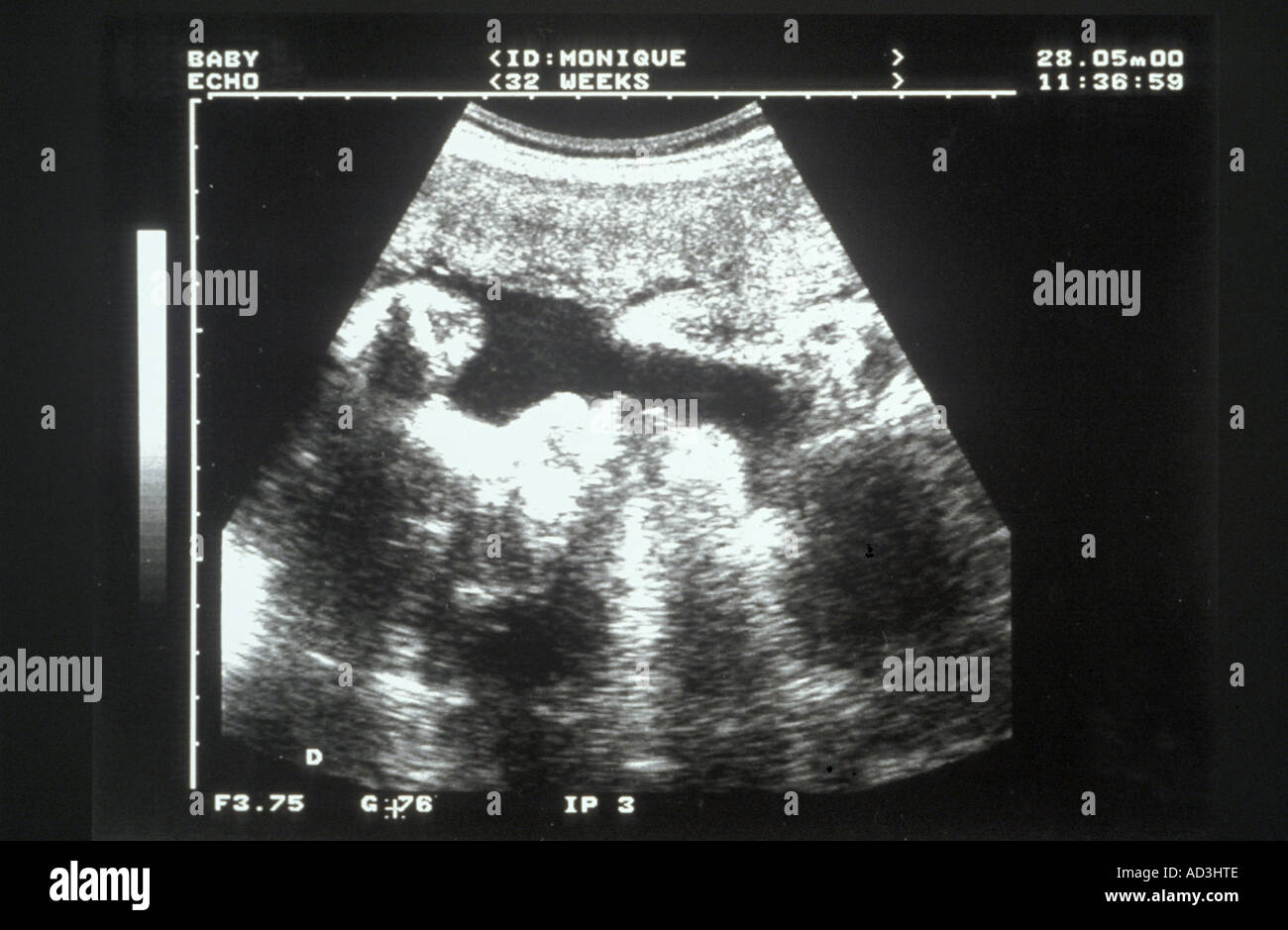 Echography of a foetus in uterus Stock Photo - Alamy
