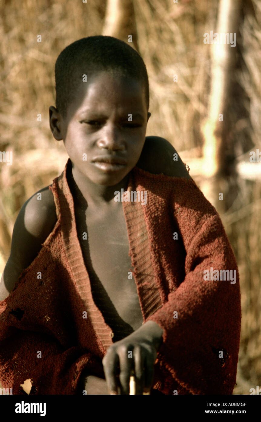 Kwashiorkor hi-res stock photography and images - Alamy