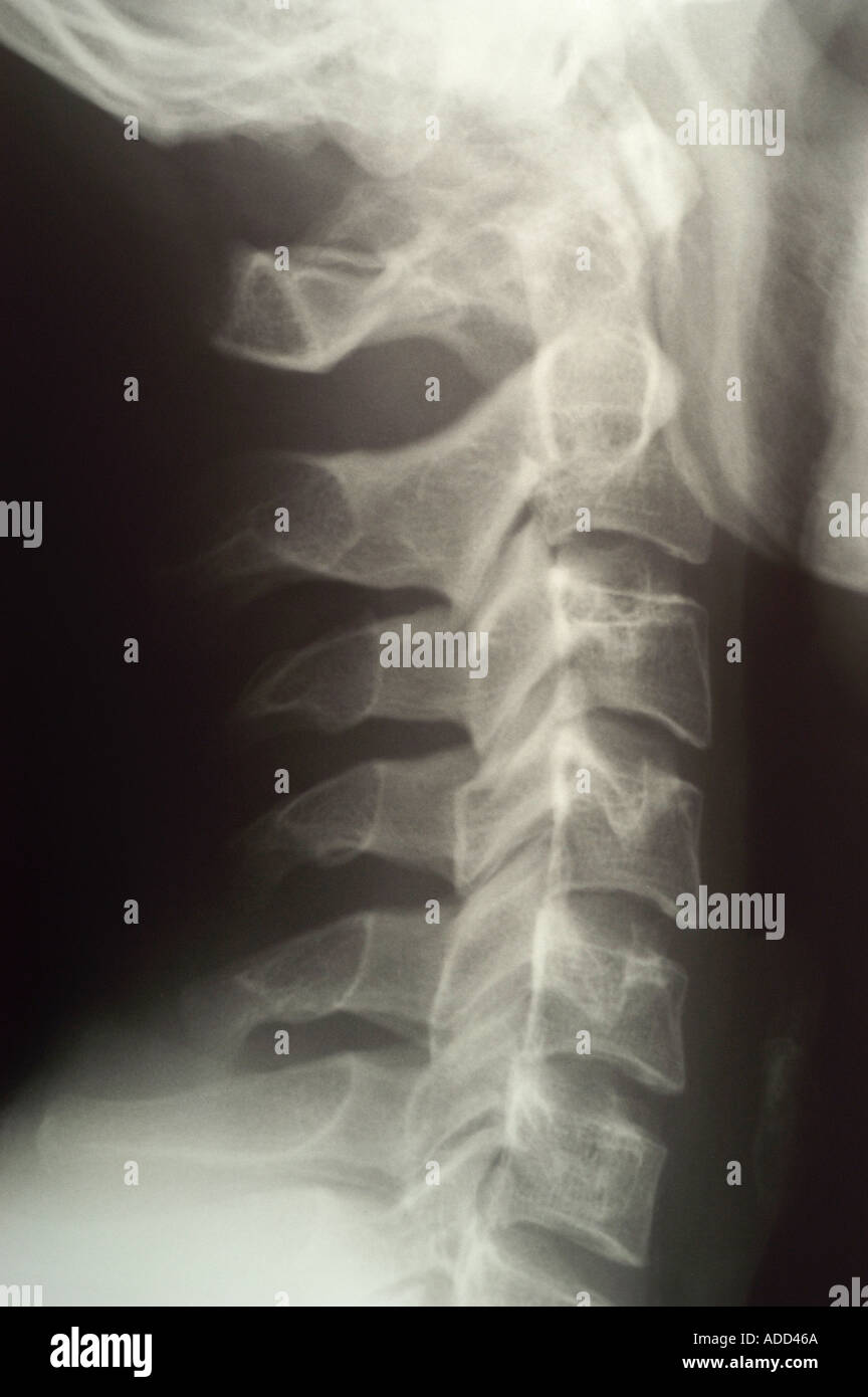 x-ray of human spinal column Stock Photo - Alamy
