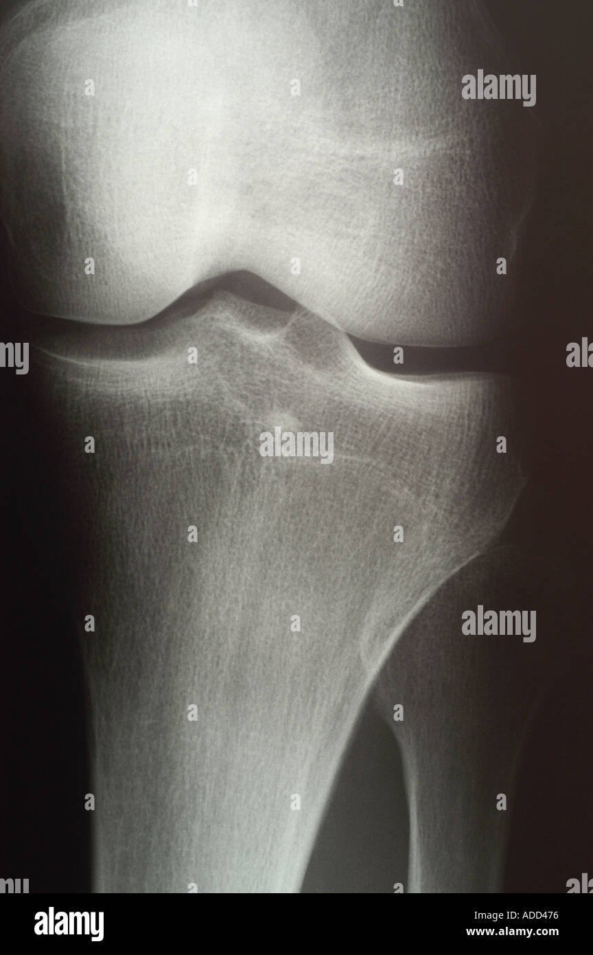 x-ray of human knee joint Stock Photo - Alamy