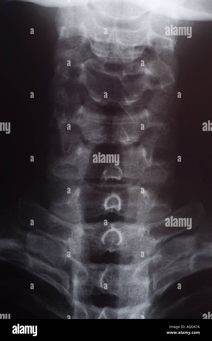 x-ray of human spinal column Stock Photo - Alamy