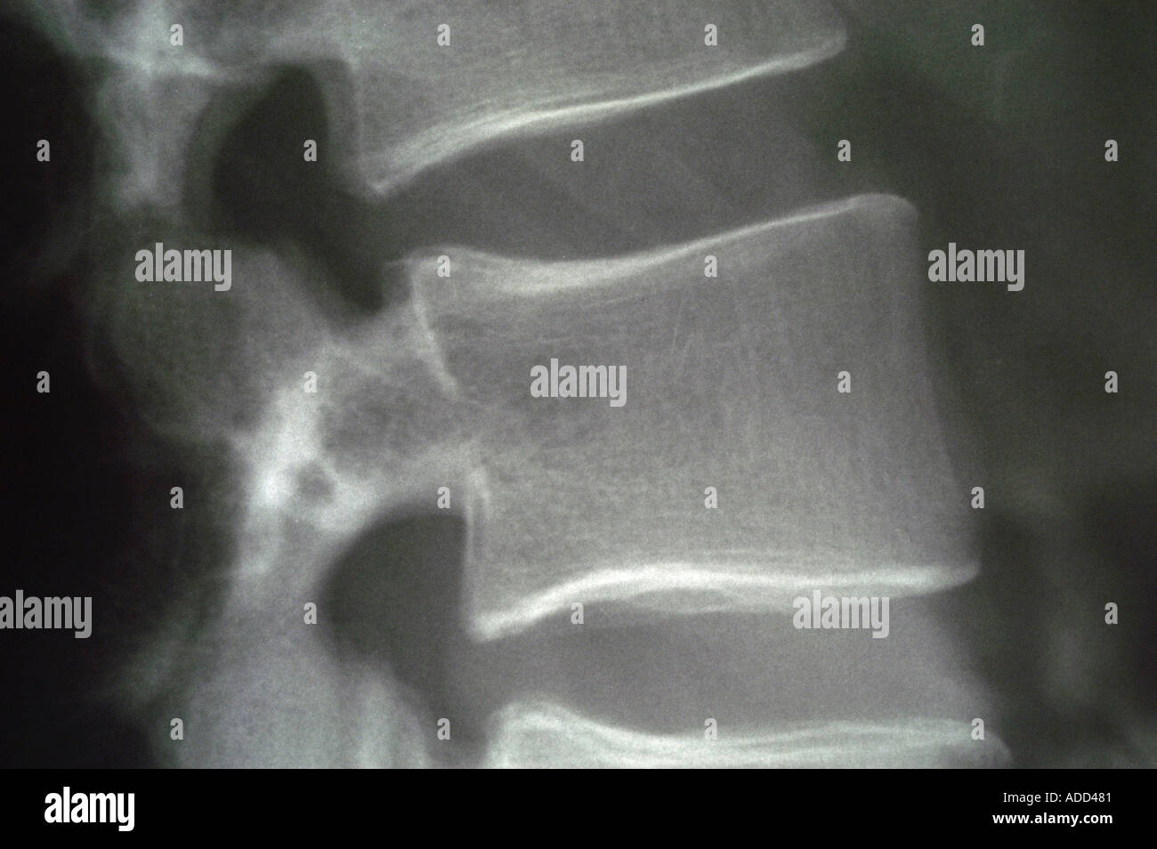 Spinal marrow hi-res stock photography and images - Alamy