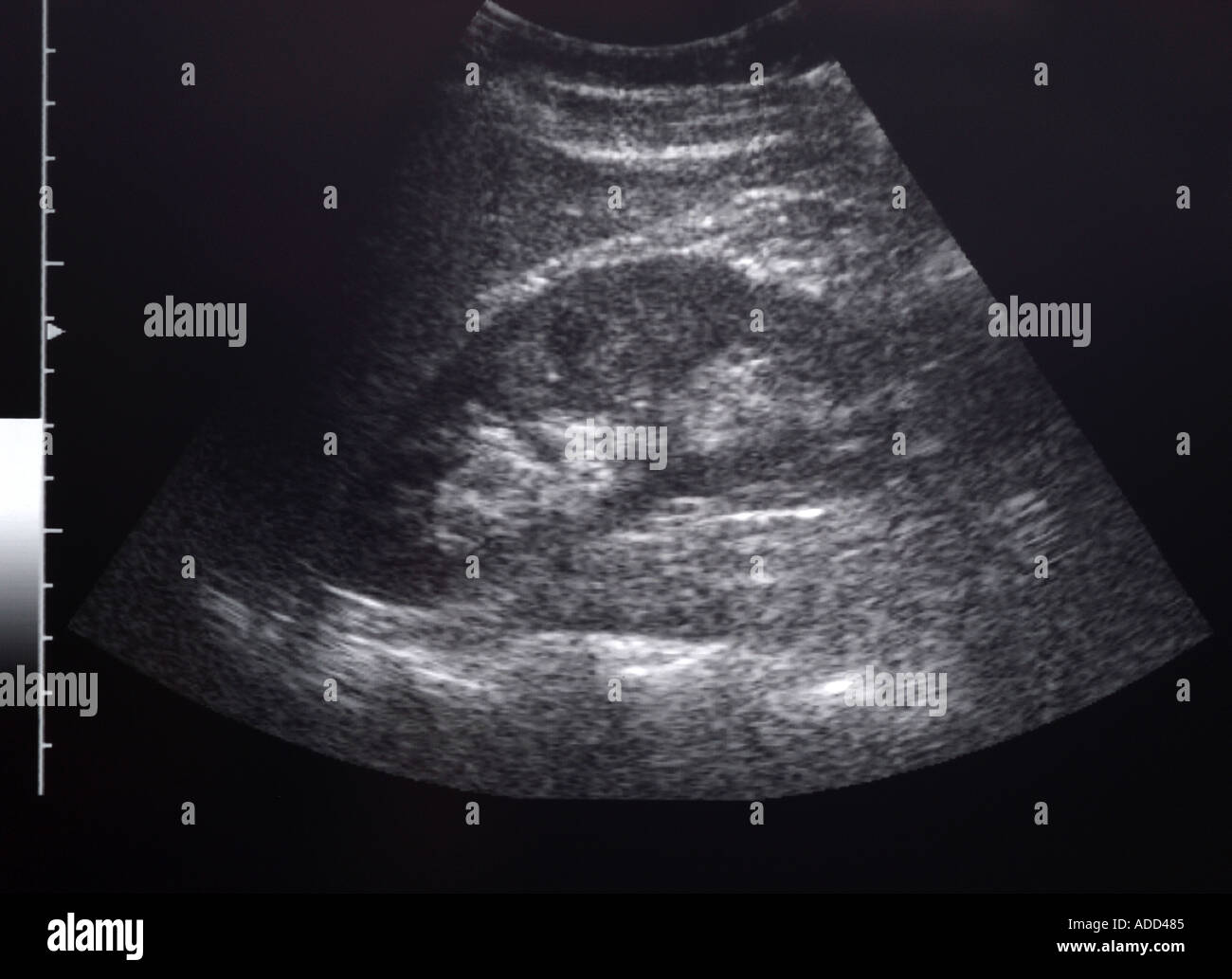 ultrasonic scan of human abdomen Stock Photo - Alamy