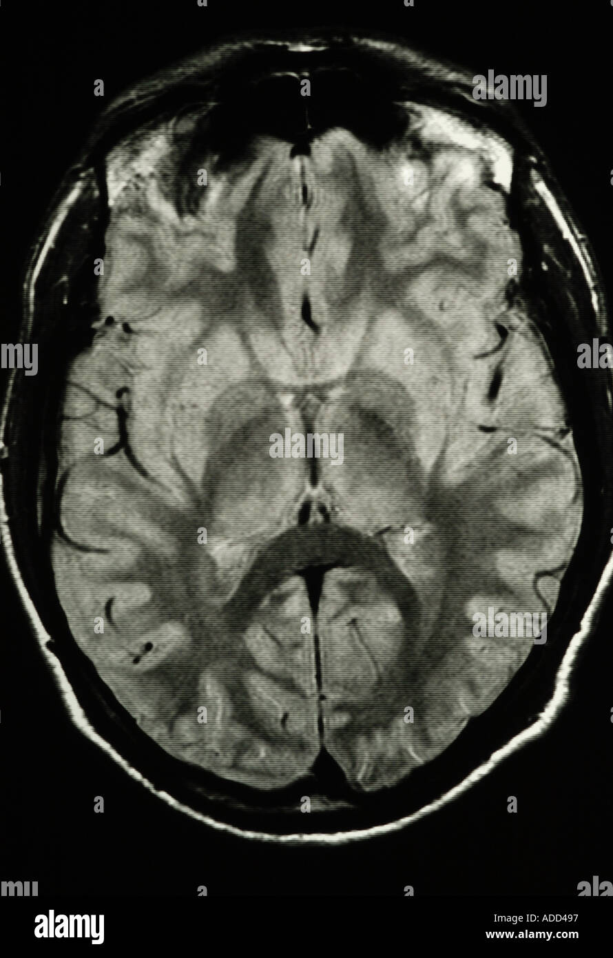 Healthy brain scan hi-res stock photography and images - Alamy