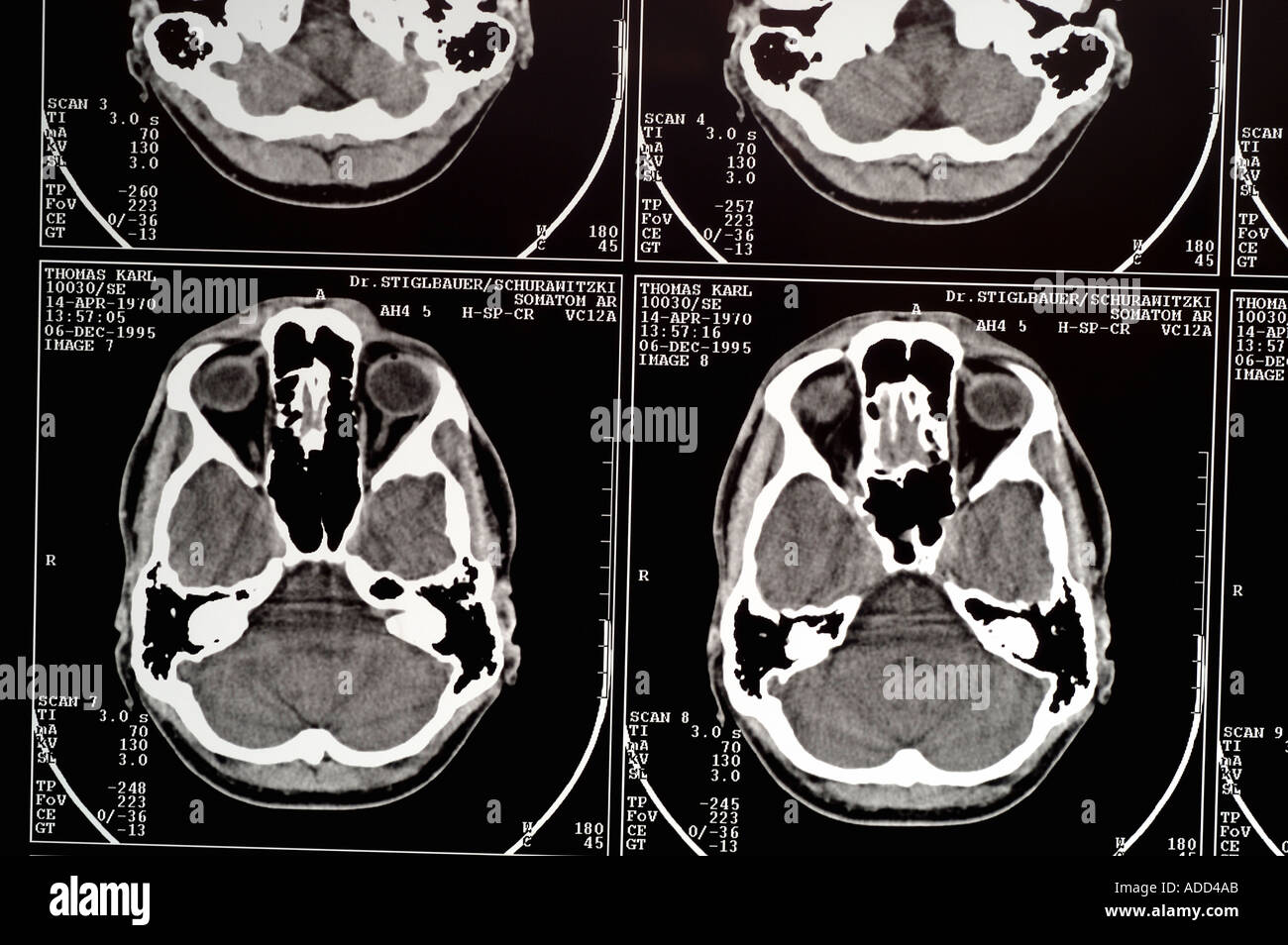 Healthy brain scan hi-res stock photography and images - Alamy