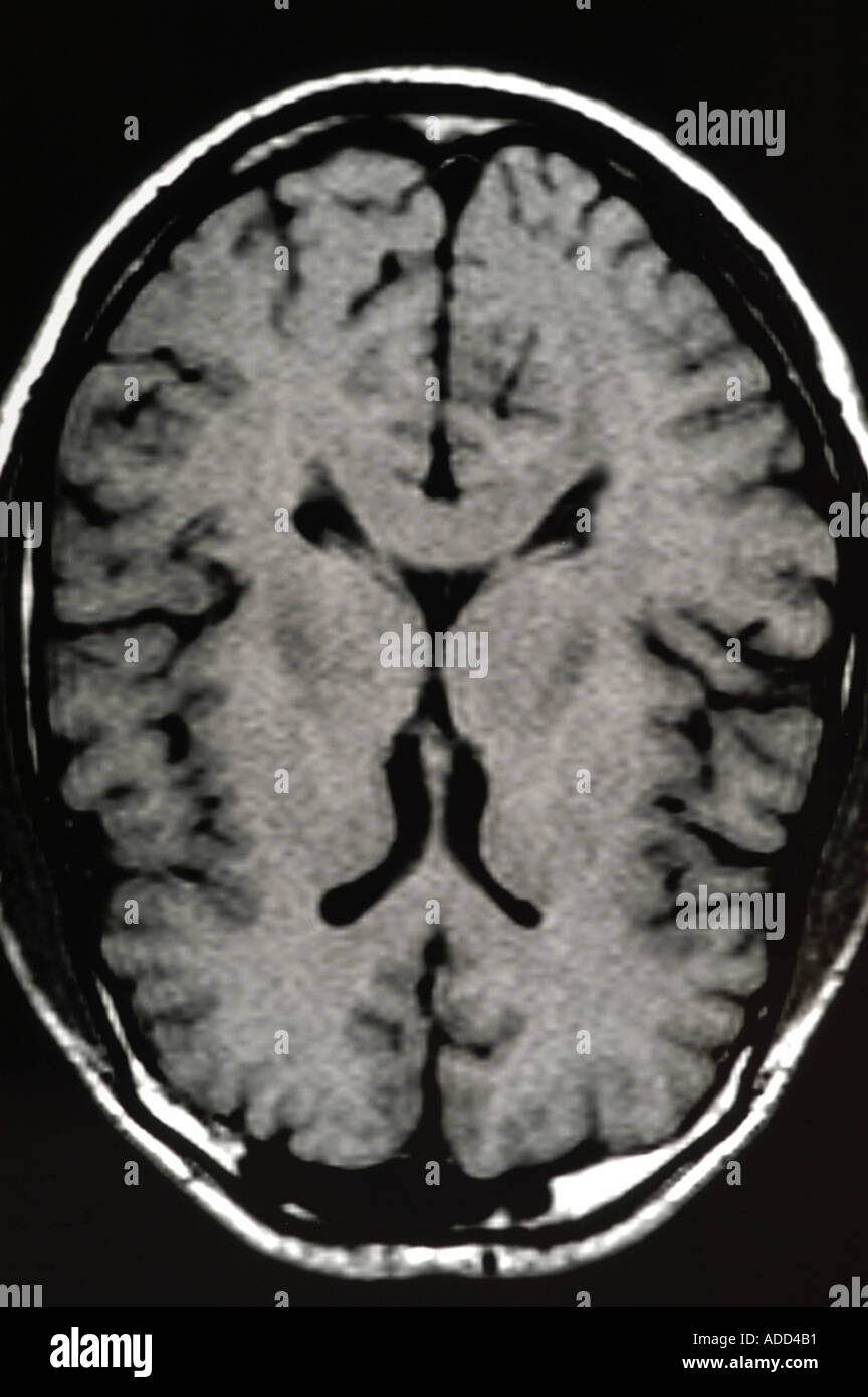 scan of human brain Stock Photo - Alamy