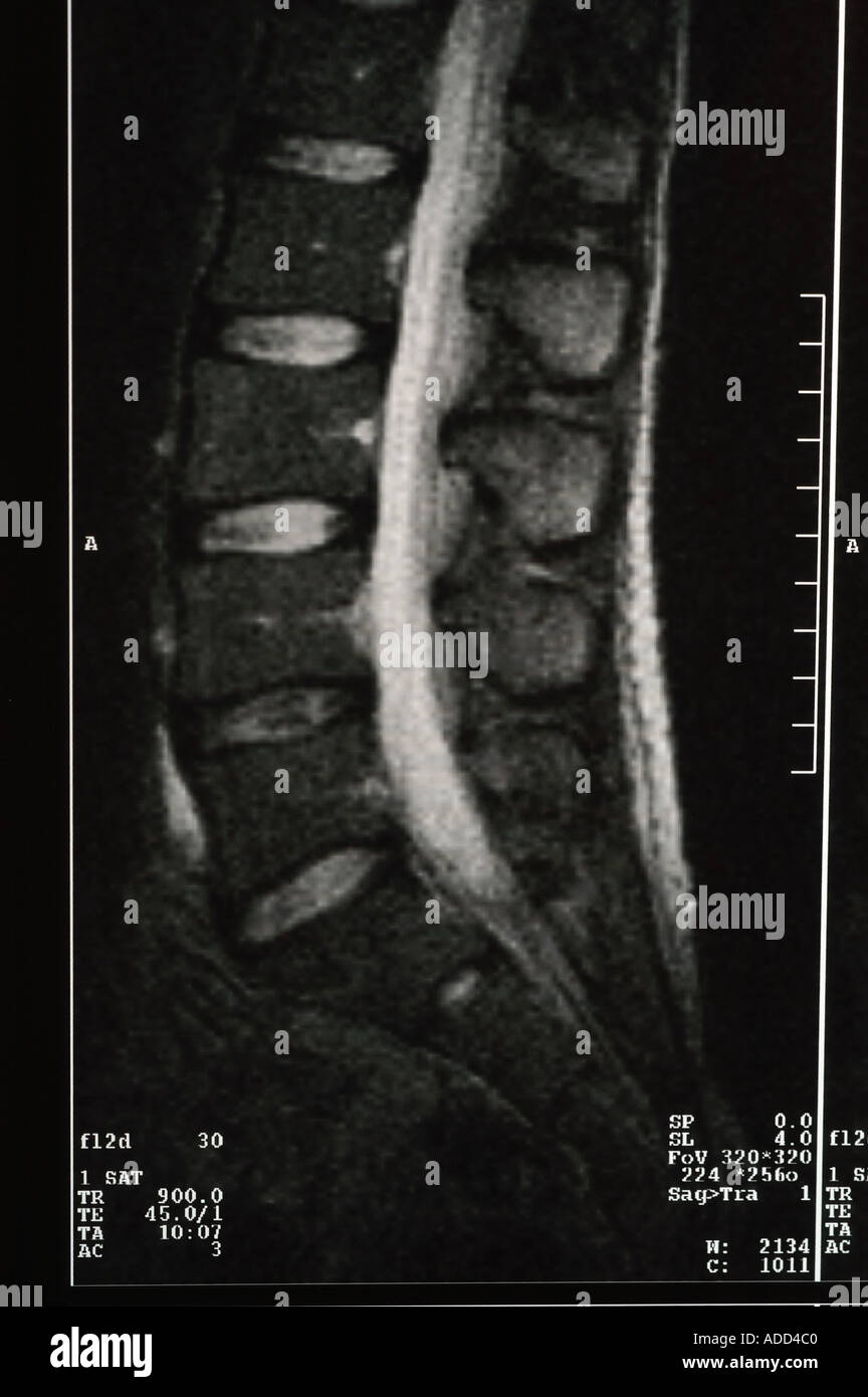 scan of human spinal column Stock Photo - Alamy