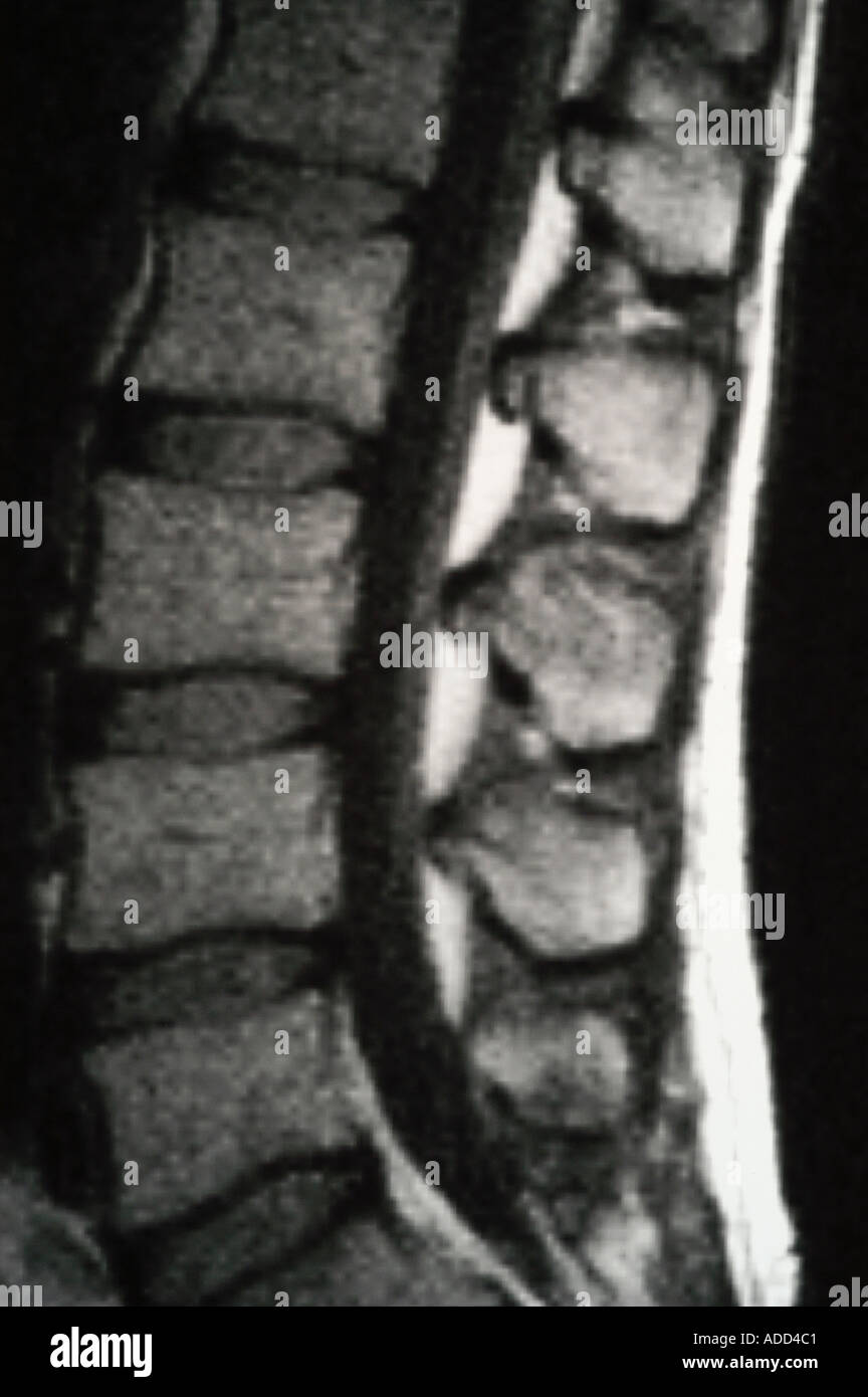 scan of human spinal column Stock Photo - Alamy
